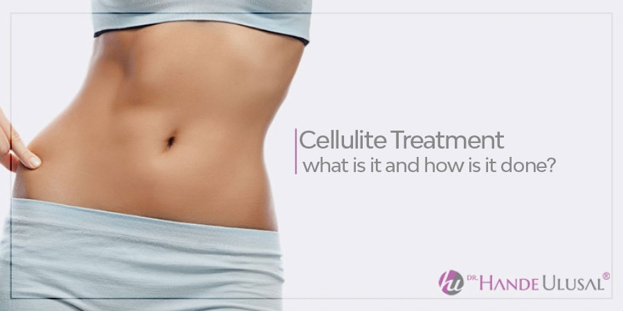 Cellulite Treatment | Dr. Hande Arda