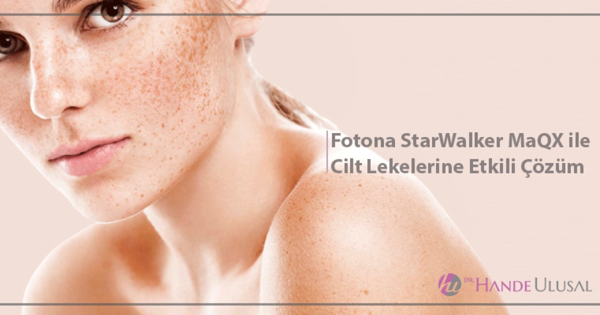 Fotona StarWalker MaQX ile Cilt Lekelerine Etkili Çözüm | Uzm. Dr ...